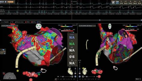 Figure 1 From Transient St Segment Elevation During Atrial Fibrillation Ablation From Septal