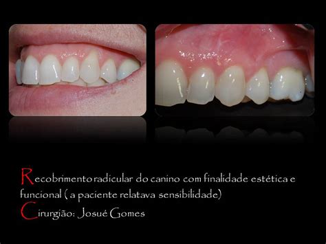 Cirurgia na Gengiva Dr Josué Gomes