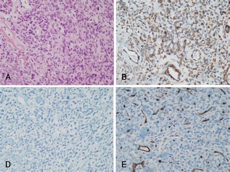 Figure 4 From A Case Of Myopericytoma In The Neck Semantic Scholar