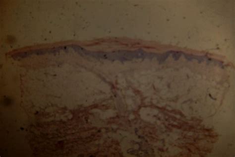Nevus Lipomatosus Superficialis Lipoid Comprehensive Dermatology