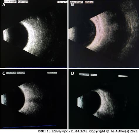 Diagnosis Of Tuberculous Uveitis By The Macrogenome Of Intraocular