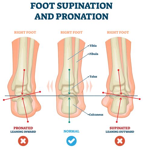 Supination Vs Pronation Whats The Difference