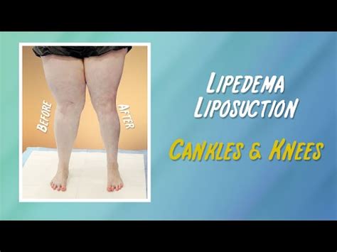 Lipedema Leg Liposuction Surgery Results Lipo Legs Cankles