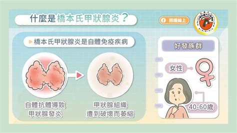脖子腫、甲狀腺機能異常，橋本氏甲狀腺炎警訊與治療 健康醫療網