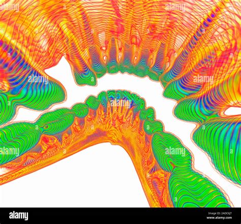 Human Teeth Digitally Enhanced 3d Computed Tomography Ct Scan Of