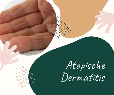 Atopische Dermatitis Just Me And Beauty