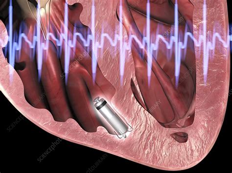 Leadless Pacemaker In Anterior Heart Stock Image C025 5228