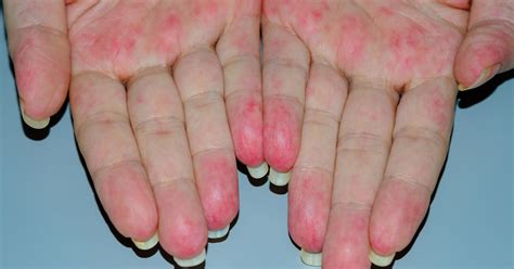 Vasculitis Blood Vessel Symptoms Causes Treatments