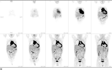 Figure 1 From Primitive Neuroectodermal Tumor Of Mediastinum In An Adult A Case Report