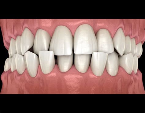 Reasons You Have Misaligned Teeth Uganda Dental Association