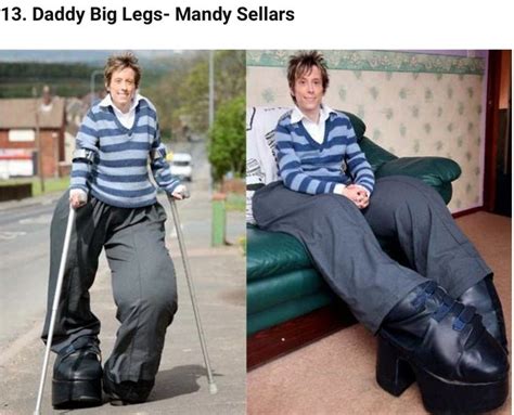 Pin By Gene Leachman On Strange Human Oddities Proteus Syndrome People
