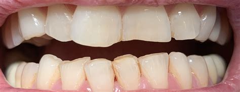 14 Tmj Splint Types Nasreenjody