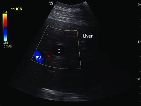 Ultrasonographic Image Showing Color Doppler Mode To Confirm Cavitary