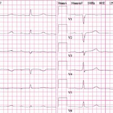 Electrocardiogram Of Year Old Woman With Poor R Wave Progression Download Scientific Diagram