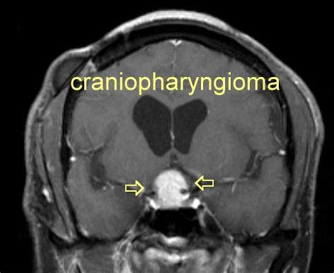 Craniopharyngioma