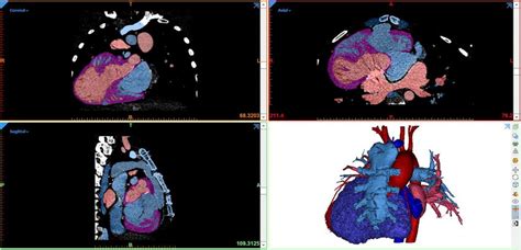 Automated And Semi Automated Segmentation Of Ct On Mimics Innovation