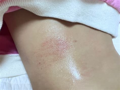 신생아 태열 아기 동전습진 아토피 초기 일까 네이버 블로그
