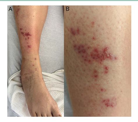 Figure 1 From Herpes Zoster Lumbar Radiculitis Semantic Scholar