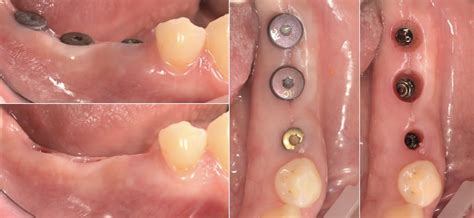 Broken Tooth Extraction Procedure