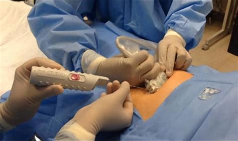 Liver Biopsy Procedure Indications Needle Names Site Risks And Complications