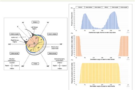Figure 1 From Prevalence And Extent Of Mitral Annular Disjunction In