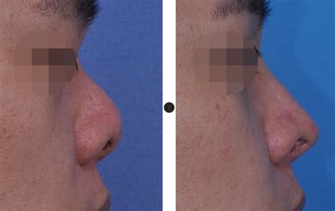 Reconstructive Nose Surgery Before And After Hanabi Rhinoplasty Clinic