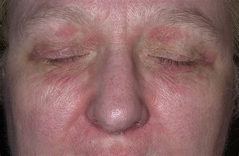 Seborrheic Dermatitis Pictures Scalp And Face Treatment Evidence