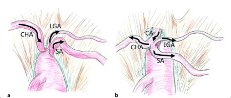Schema Of Visceral Perfusion A Before Median Arcuate Ligament