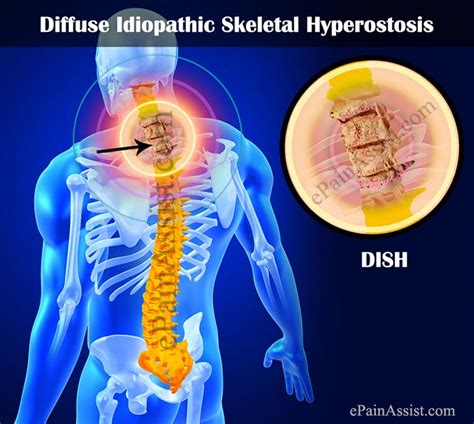 Diffuse Idiopathic Skeletal Hyperostosis Dish Or Forestiers Disease Treatment