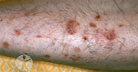 Diabetic Dermopathy Image
