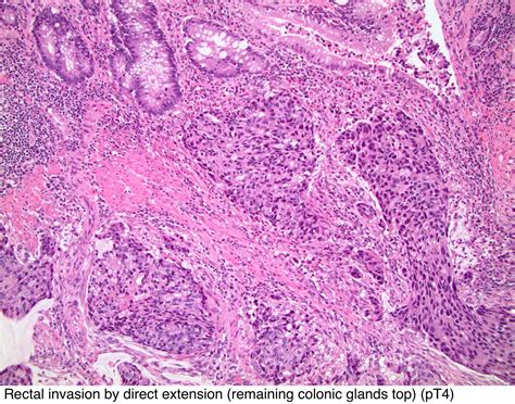 Pathology Outlines Staging
