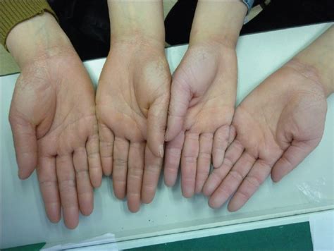 Hereditary Papulotranslucent Acrokeratoderma A Simultaneous Presentation In Daughter And Mother