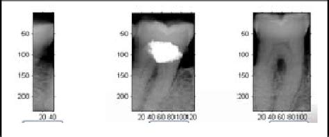 Figure 2 From Algorithm To Identify Enamel Caries And Interproximal