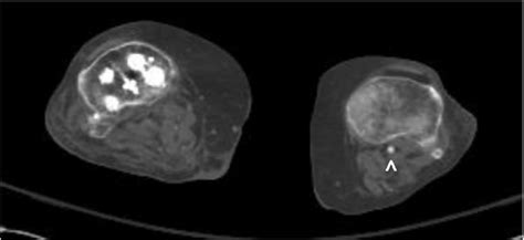 Ct Angiogram Of Bilateral Lower Extremities At The Level Of The Tibial