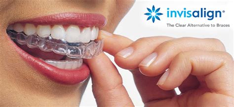 Como Funciona O Invisalign Raaro Odontologia E Bem Estar