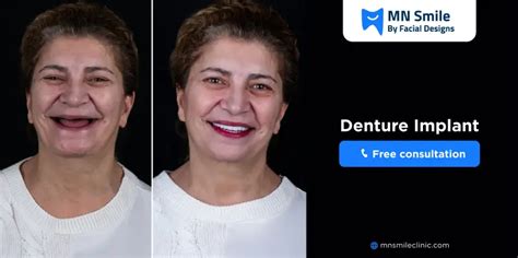 Affordable Denture Implants Transforming Your Smile On A Budget Mn