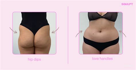 Hip Dips Vs Love Handles Differences And Solutions Squlpt