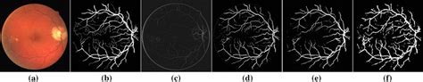 vessel segmentation of different methods on a sample from drive