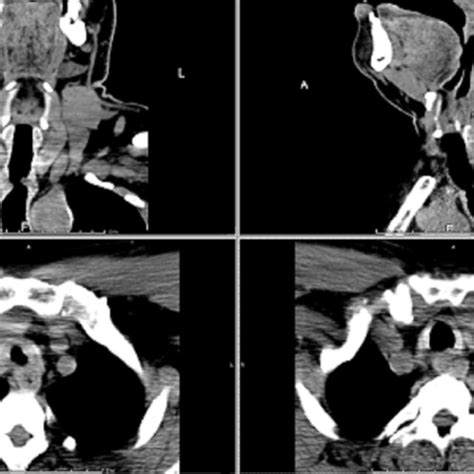 Ct Scan With Multiplanar Reconstructions Of A Patient Affected By Download Scientific Diagram