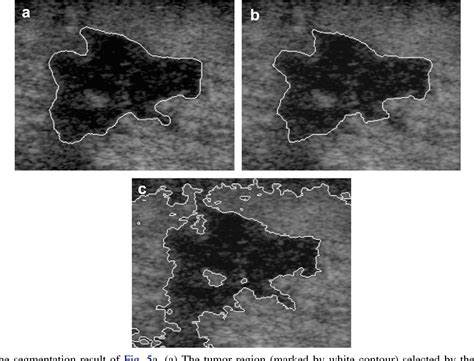 Figure 8 From Automated Segmentation Of Ultrasonic Breast Lesions Using Statistical Texture