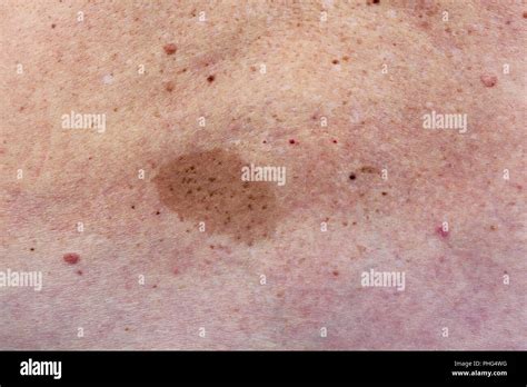 Brown Birthmark