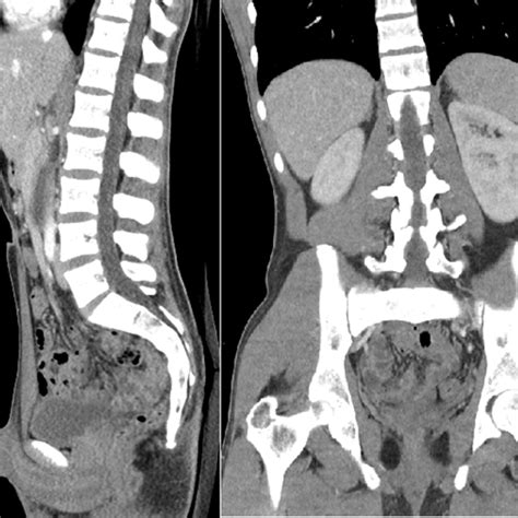 Difference Between CT Abdomen CT Abdomen With Conrast Scanning