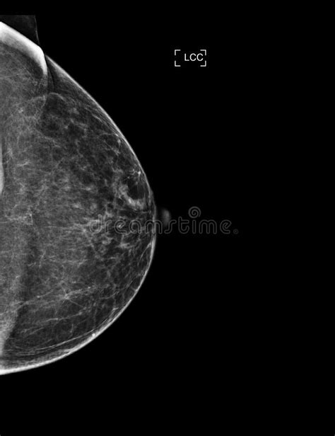 X Ray Digital Mammogram Or Mammography Of Both Side Breast Showing