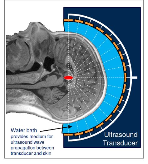 Figure 1 1 From Automated Volumetric Skull Segmentation Utilizing Ultra