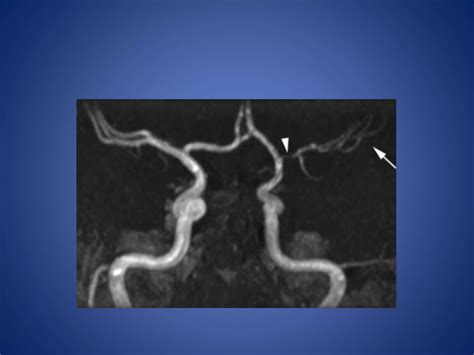 Pediatric Stroke Radiology Pptx