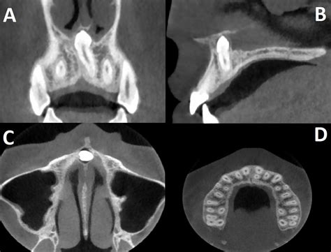 Anterior Nasal Spine Radiograph