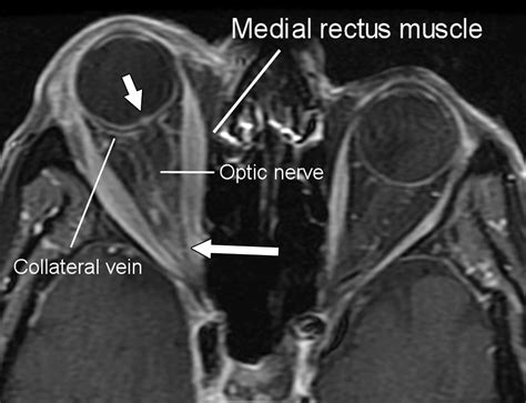 Orbit Mri Anatomy