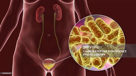 Bacterial Cystitis Illustration High Res Vector Graphic Getty Images