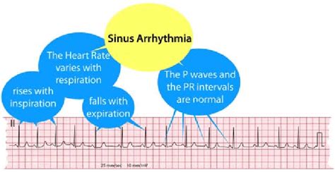 Respiratory Sinus Arrhythmia