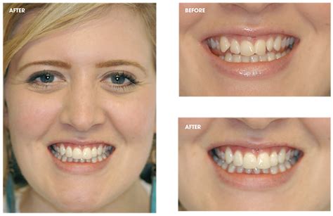Cosmetic Tooth Alignment With Cfast Fairwater Green Dental Practice